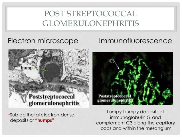 Glomerular diseases