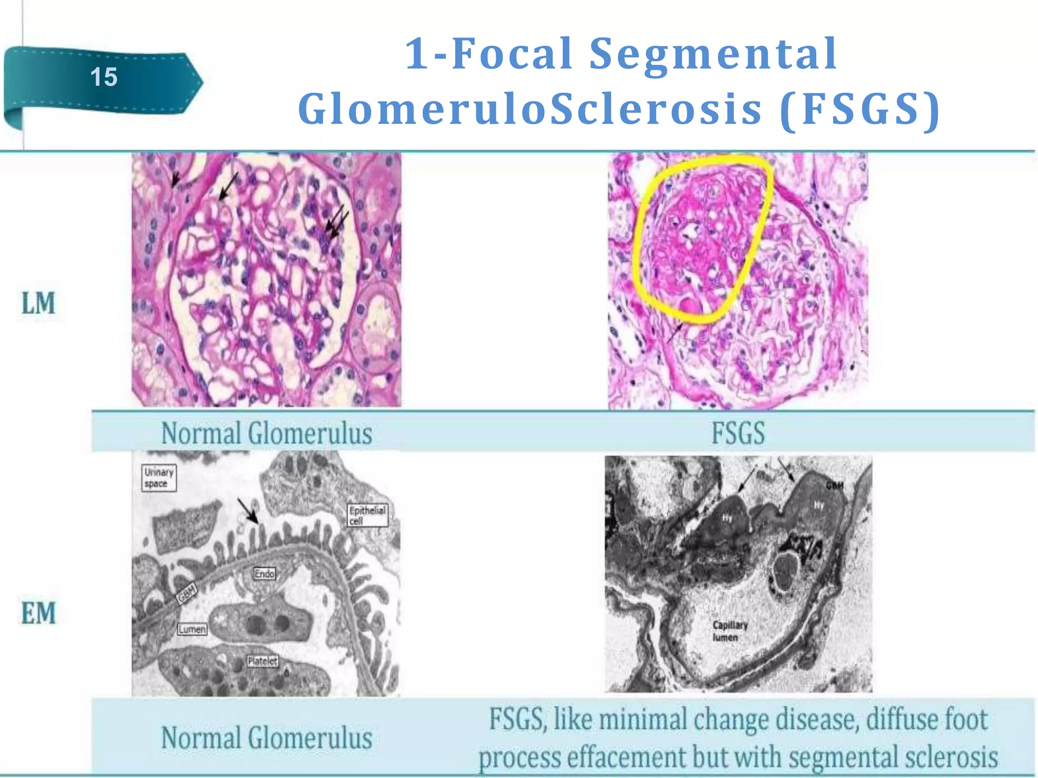 Glomerular Diseases.pptx