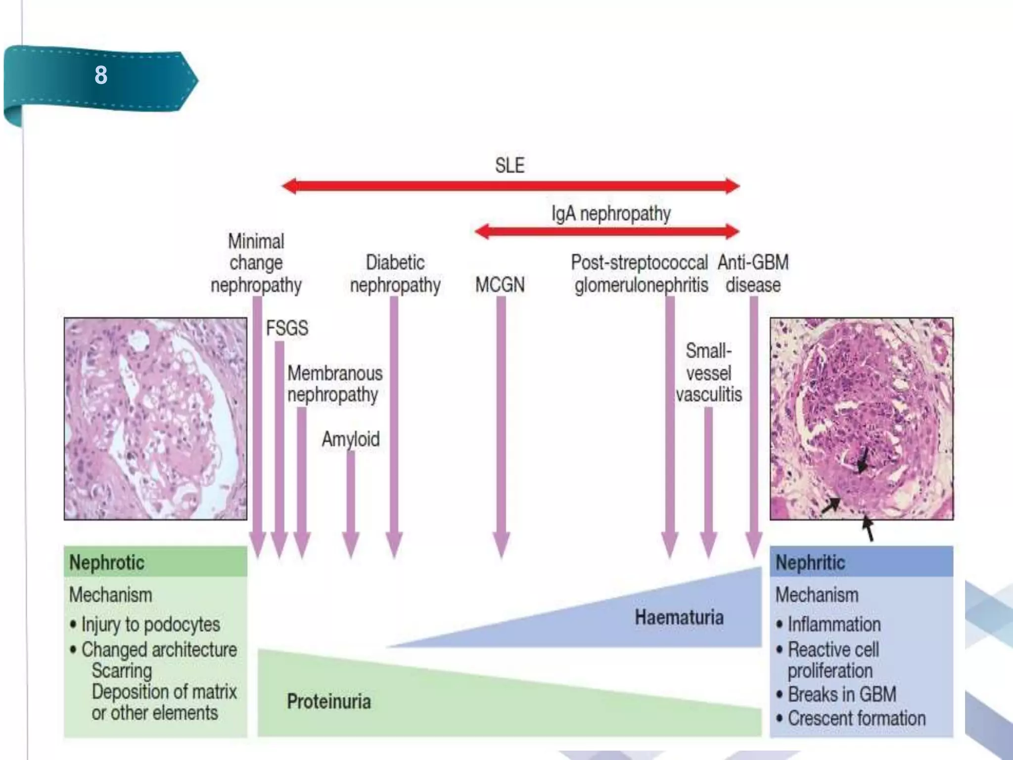Glomerular Diseases.pptx