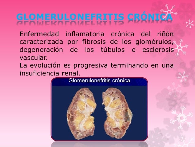 Glomerulonefritis