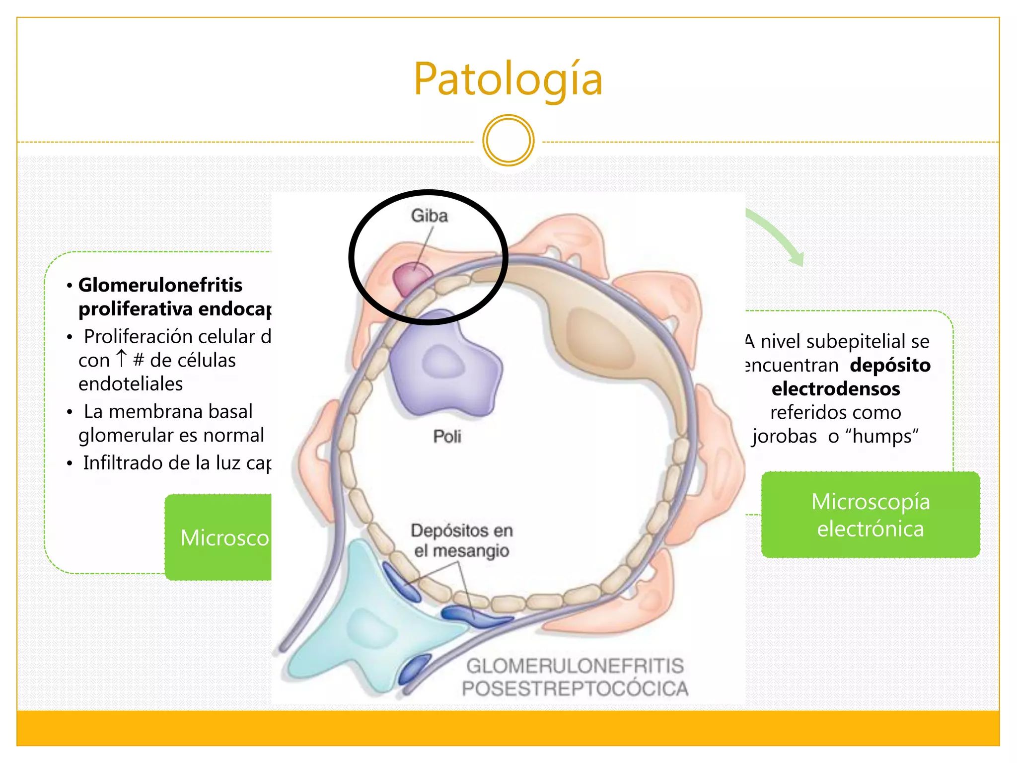 Glomerulonefritis aguda post infecciosa | PDF