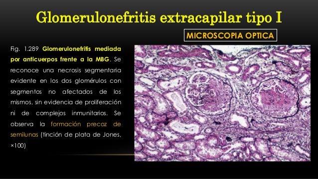 NEFROLOGIA CLINICA: Glomerulonefritis rapidamente progresiva