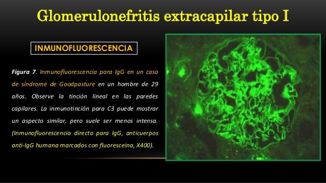 NEFROLOGIA CLINICA: Glomerulonefritis rapidamente progresiva
