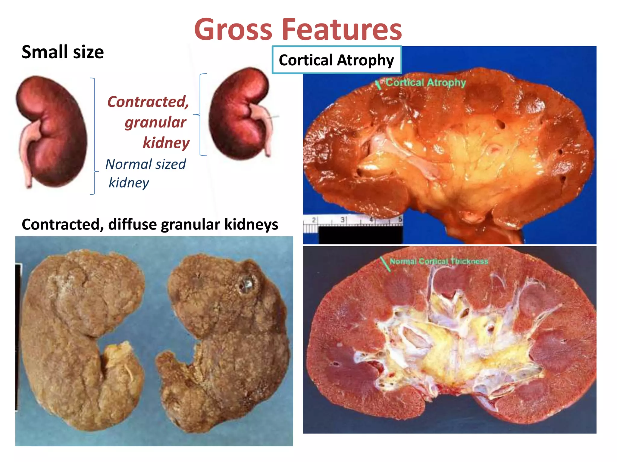 Chronic Glomerulonephritis | PPTX