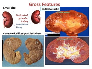 Chronic Glomerulonephritis | PPTX