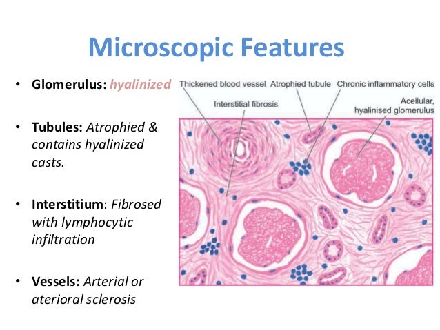 Chronic Glomerulonephritis