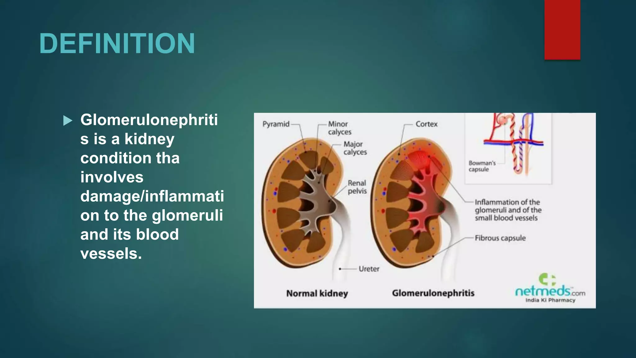 Glomerulonephritis | PPTX