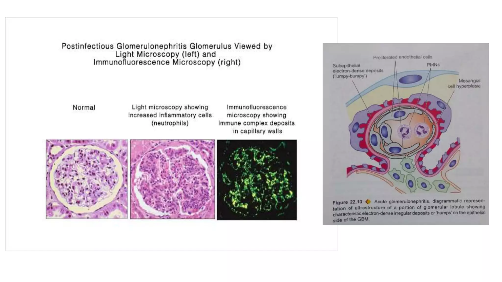 Kidney disease GLOMERULONEPHRITIS.pptx