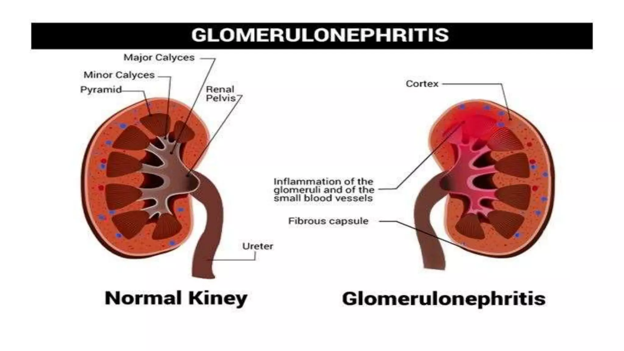 Kidney disease GLOMERULONEPHRITIS.pptx
