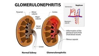 GLOMERULONEPHRITIS. inflammation of the glomeruli, the filtering units ...