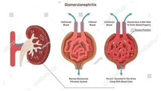 GLOMERULONEPHRITIS. inflammation of the glomeruli, the filtering units ...