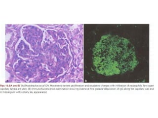 GLOMERULONEPHRITIS in children - Pediatrics | PPTX