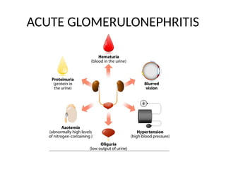 GLOMERULONEPHRITIS in children - Pediatrics | PPTX