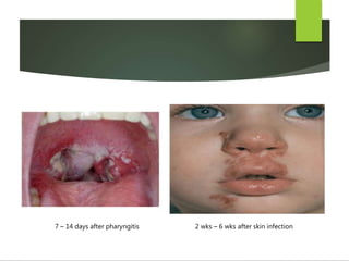 Acute Glomerulonephritis | PPTX