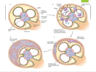 Acute Glomerulonephritis | PPTX