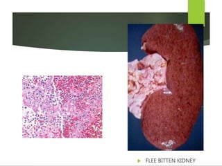 Acute Glomerulonephritis | PPTX