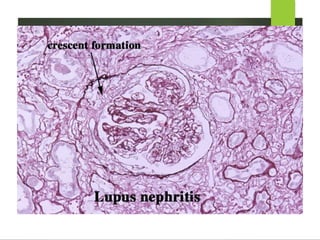 Acute Glomerulonephritis | PPTX
