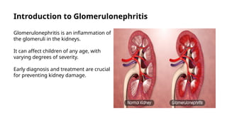 Glomerulonephritis In Children 2.pptx mbbs | PPTX