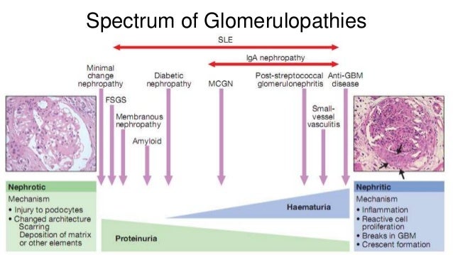 Crescentric Glomerulonephritis (RPGN)