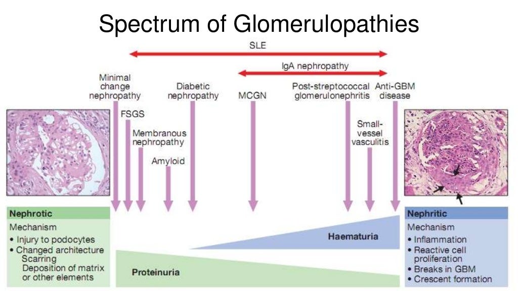 Crescentric Glomerulonephritis (RPGN)