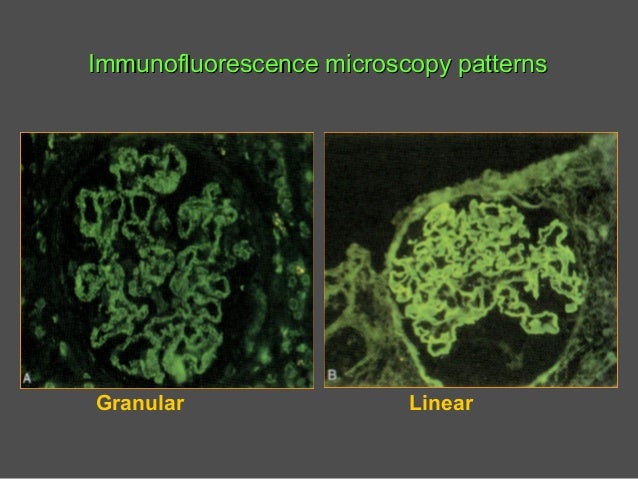 Glomerulus and nephrotic & nephritic syndrome