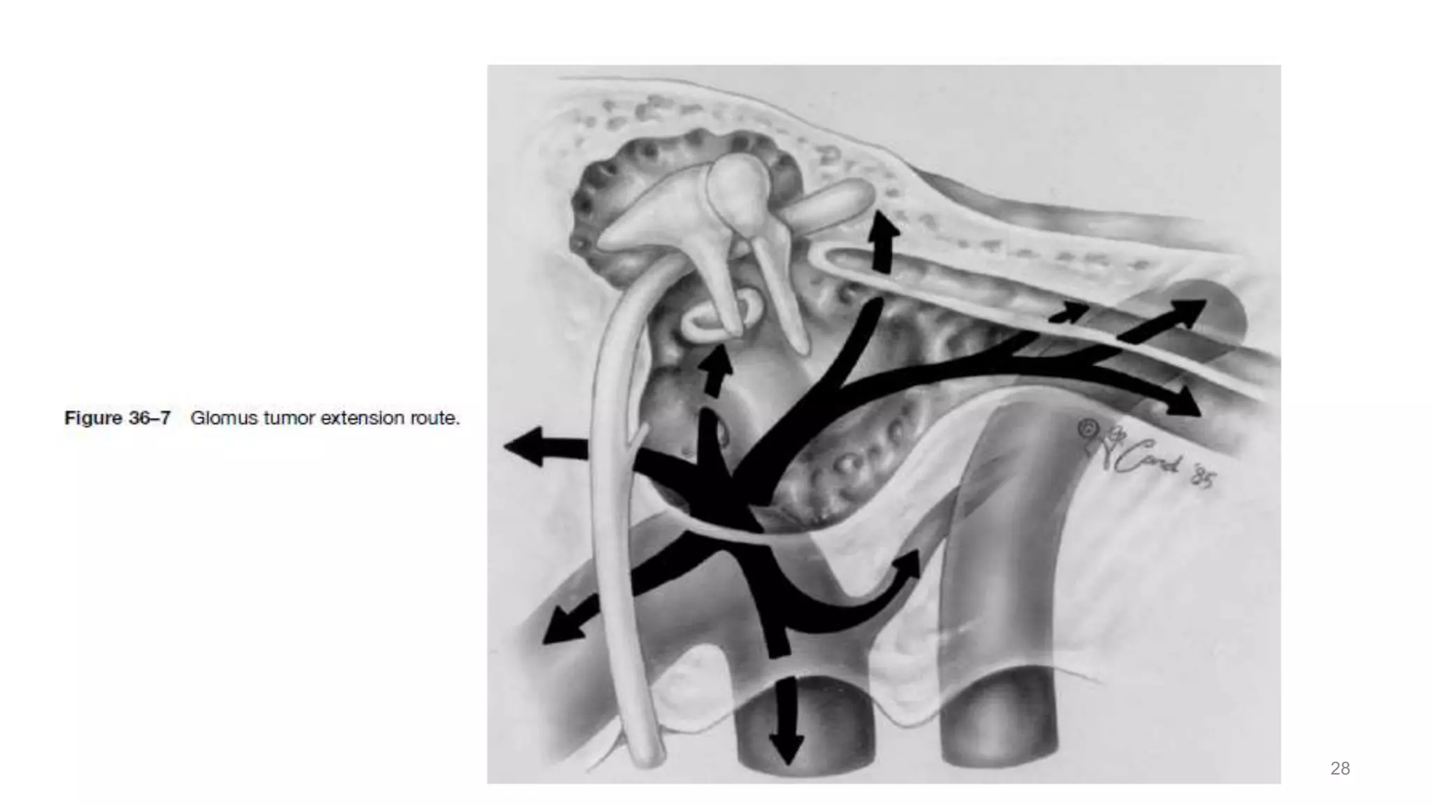 Glomus Tumour | PPTX