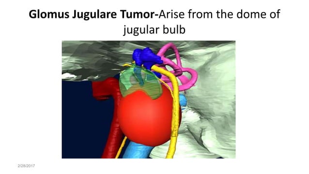 Glomus Tumour | PPTX | Ear, Nose and Throat Conditions | Diseases and ...