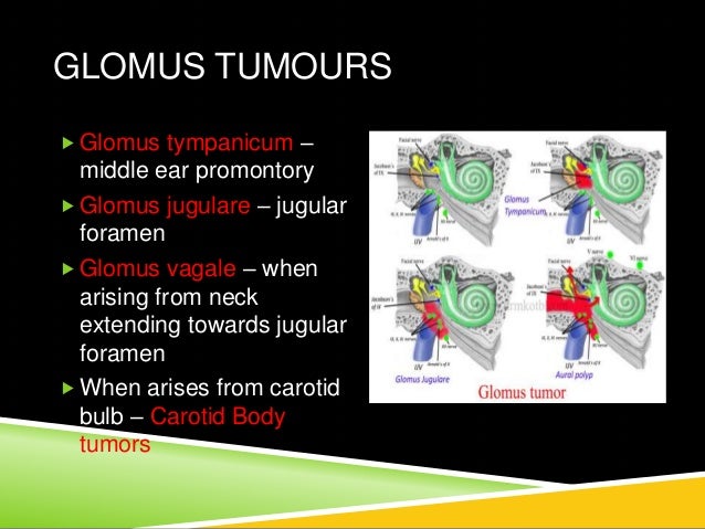 Glomus tumors