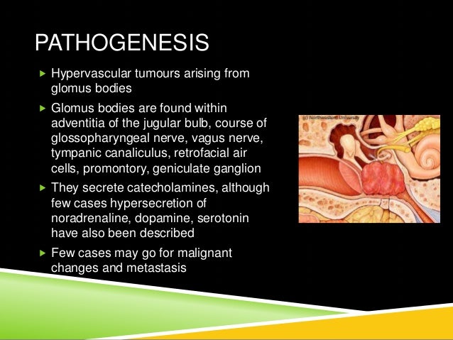 Glomus Tumors