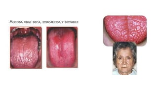 Glositis | PPTX