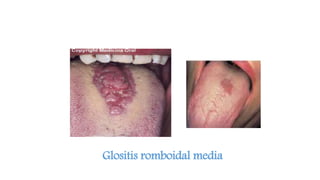 Glositis Romboidal Media: Causas Y Mas – IAHPB