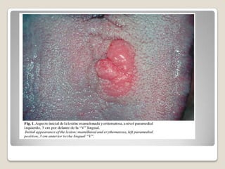 Glositis romboidal media | PPTX