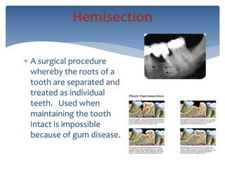 introduction to endodontics | PDF