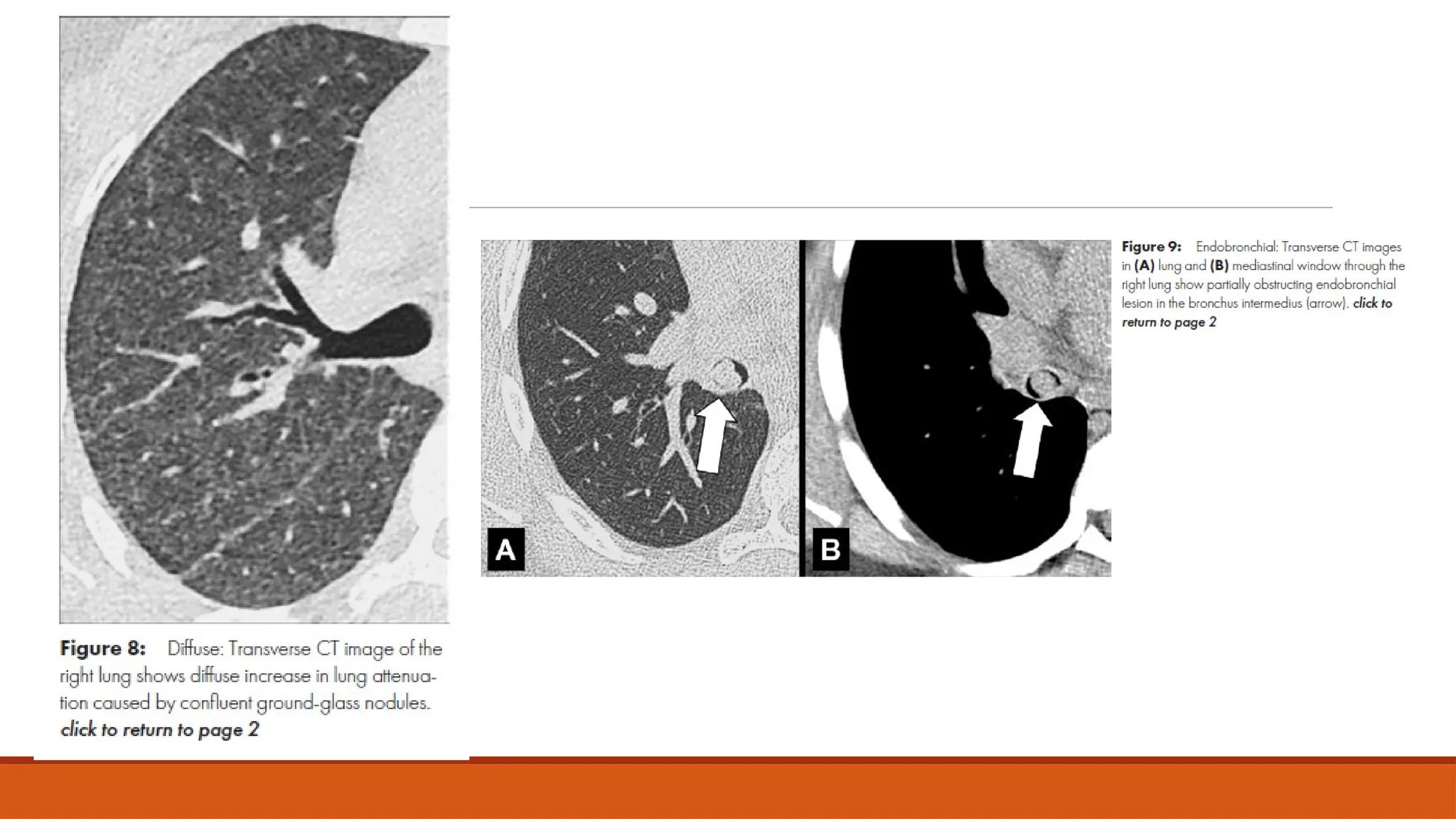 Glossary of terms in Thoracic Radiology: The Fleischner Society 2024 ...
