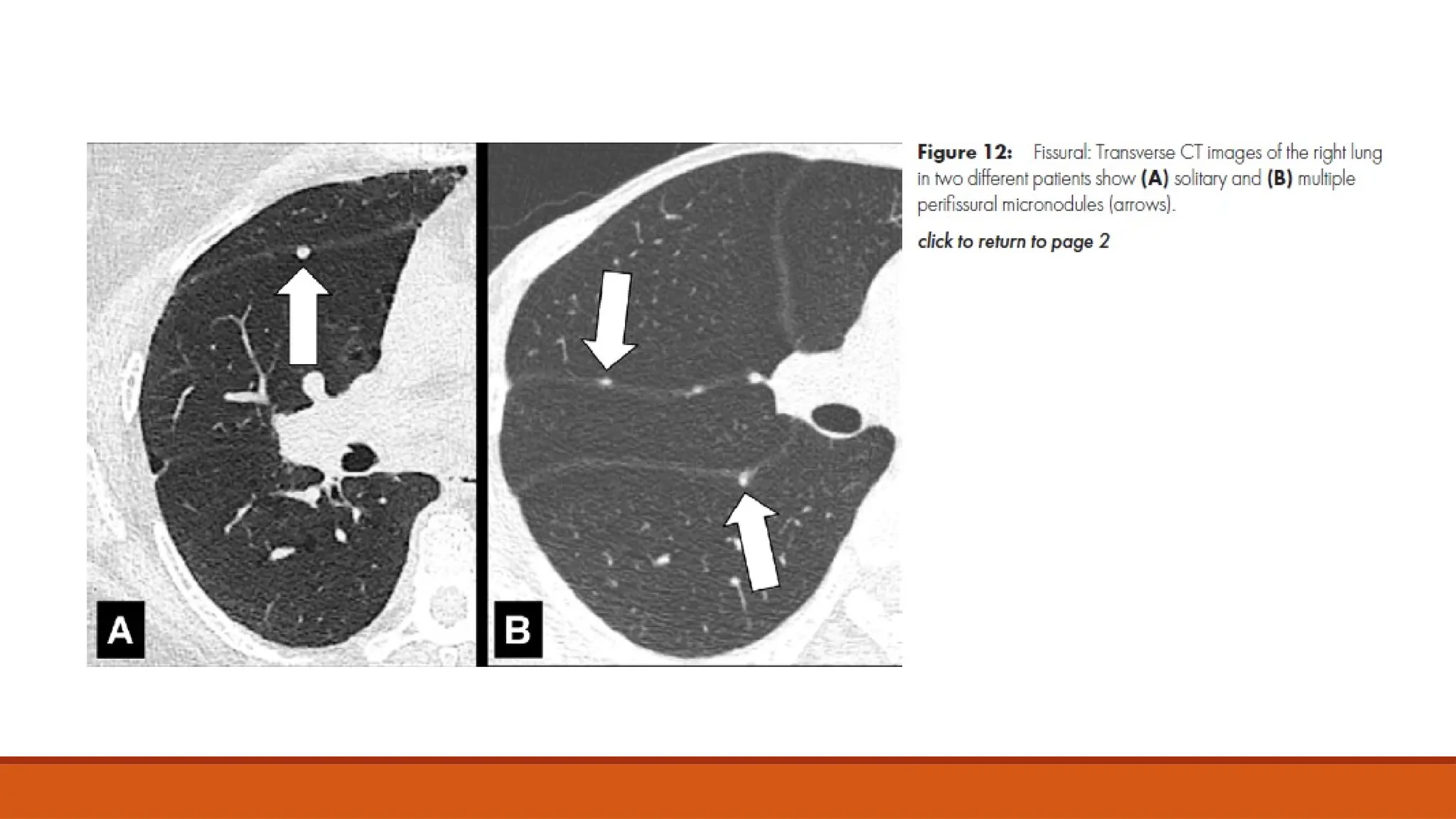 Glossary of terms in Thoracic Radiology: The Fleischner Society 2024 ...