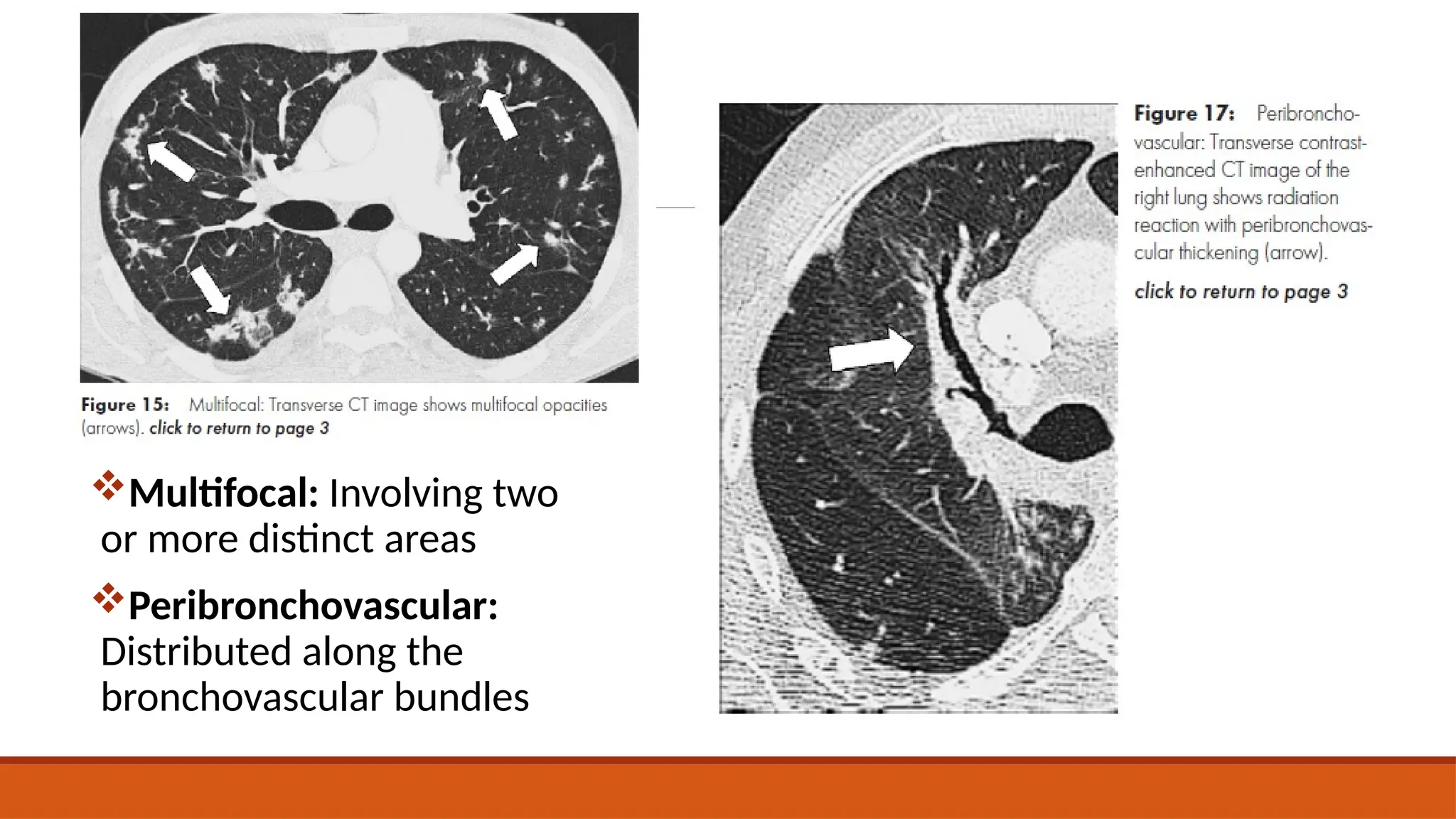 Glossary of terms in Thoracic Radiology: The Fleischner Society 2024 ...