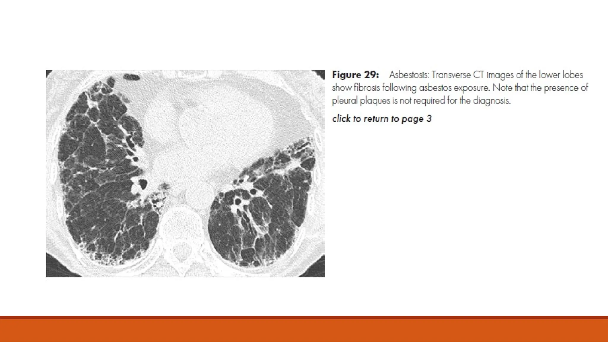 Glossary of terms in Thoracic Radiology: The Fleischner Society 2024 ...