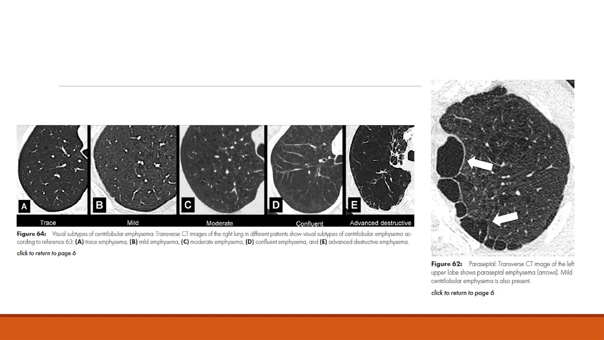 Glossary of terms in Thoracic Radiology: The Fleischner Society 2024 ...