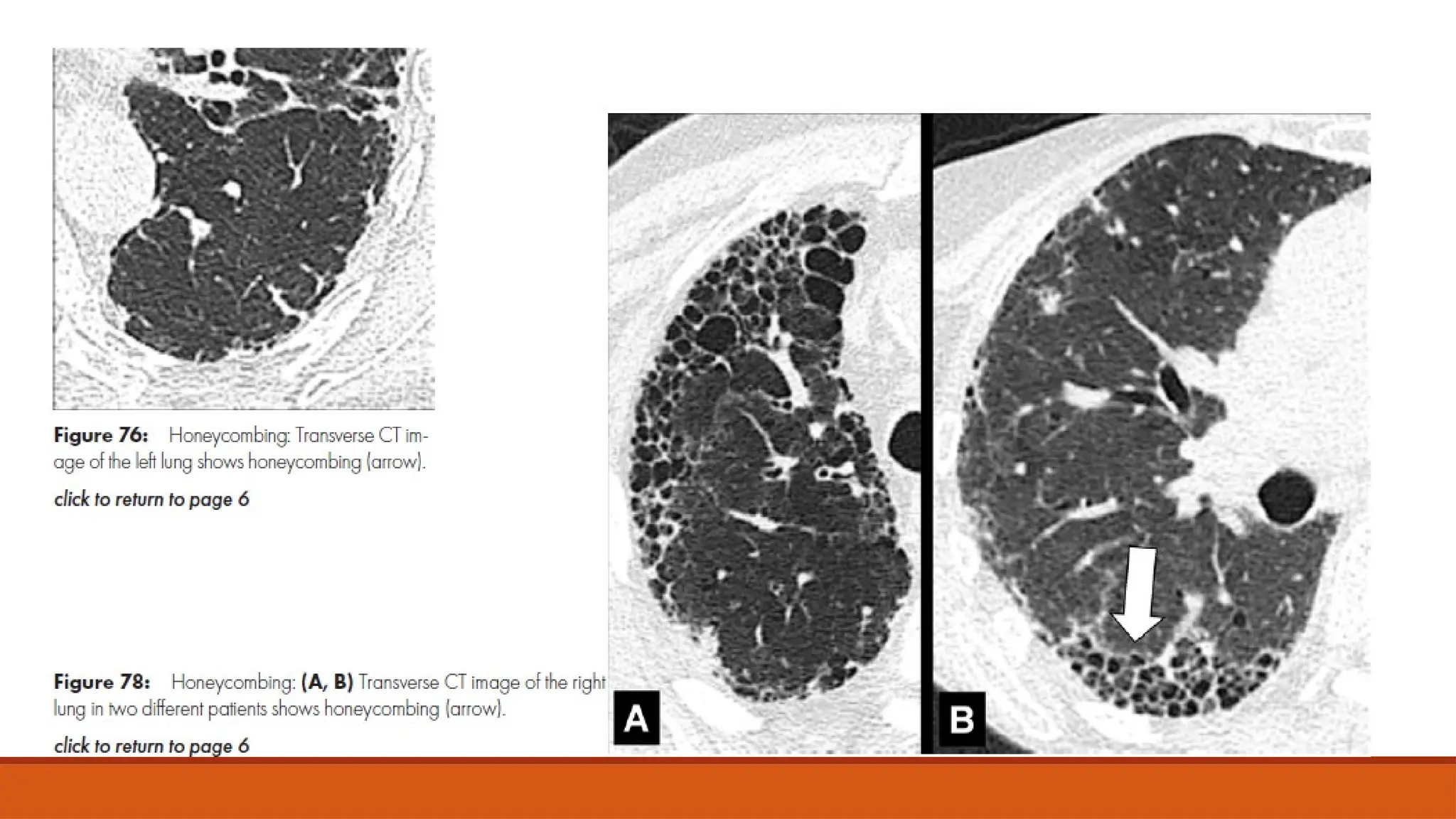Glossary of terms in Thoracic Radiology: The Fleischner Society 2024 ...