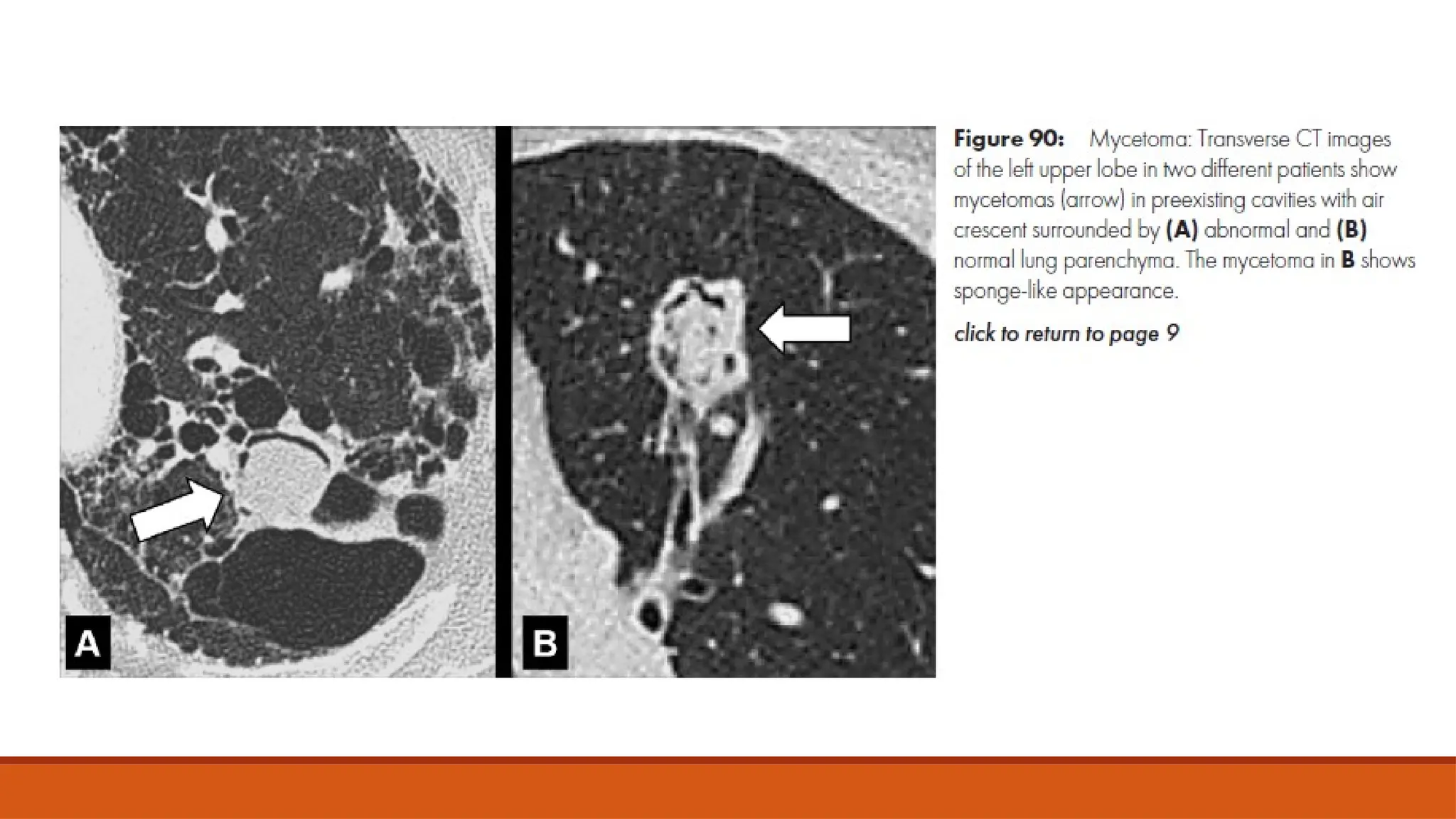 Glossary of terms in Thoracic Radiology: The Fleischner Society 2024 ...