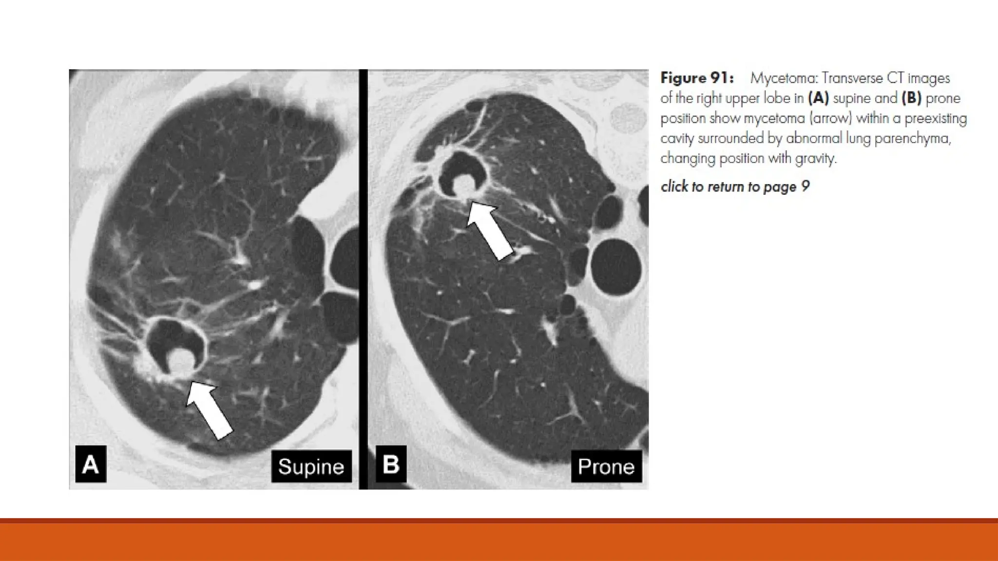 Glossary of terms in Thoracic Radiology: The Fleischner Society 2024 ...