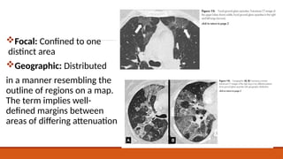 Glossary of terms in Thoracic Radiology: The Fleischner Society 2024 ...