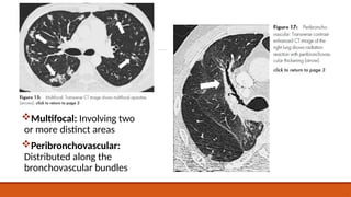 Glossary of terms in Thoracic Radiology: The Fleischner Society 2024 ...