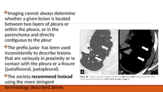 Glossary of terms in Thoracic Radiology: The Fleischner Society 2024 ...