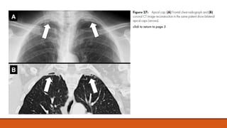 Glossary of terms in Thoracic Radiology: The Fleischner Society 2024 ...