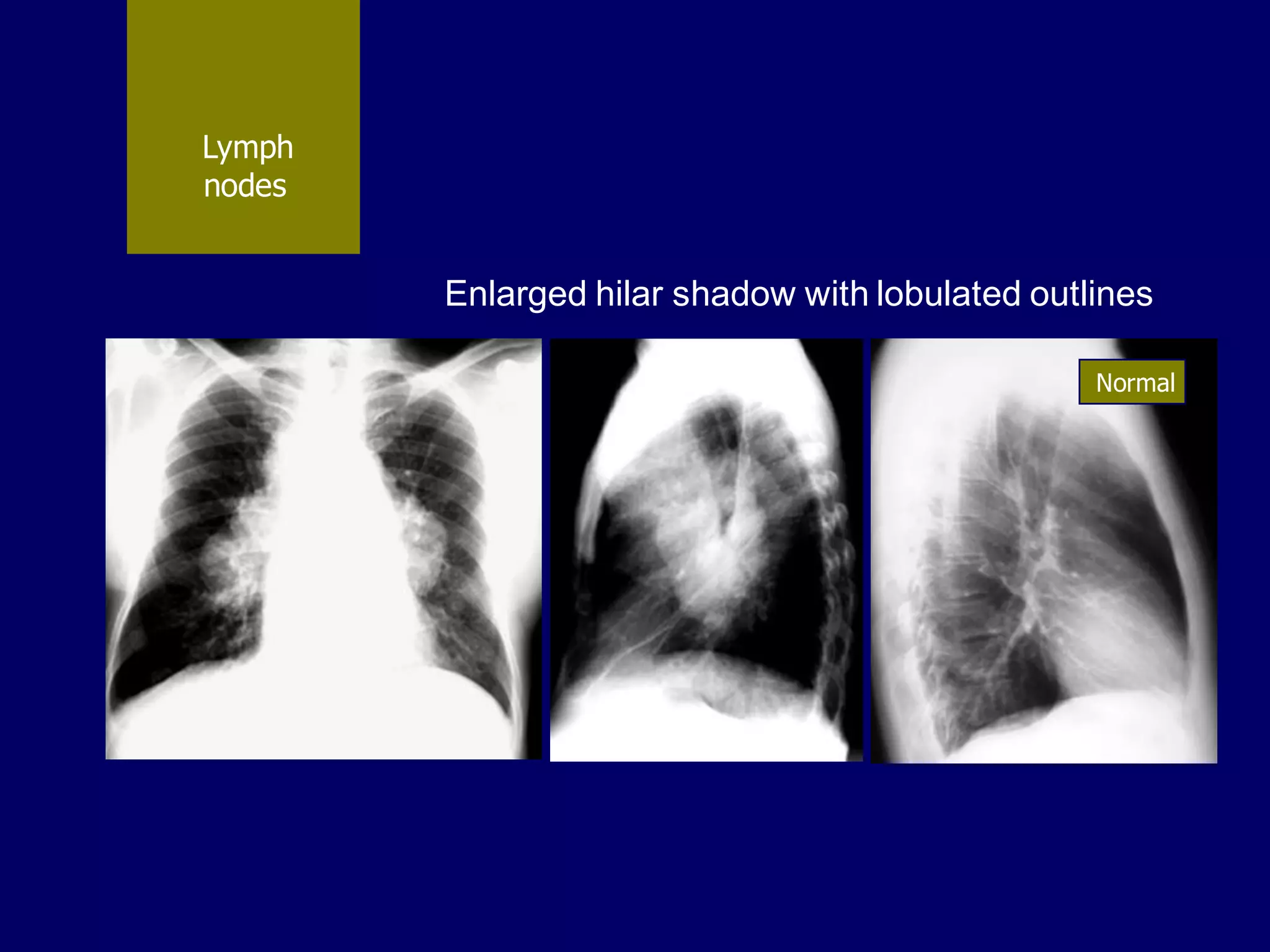Glossary of thoracic imaging terms part 1 | PDF