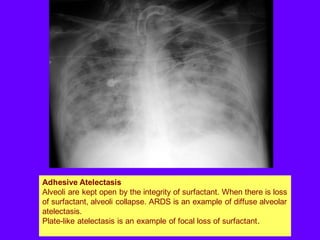 Glossary of thoracic imaging terms part 1 | PDF