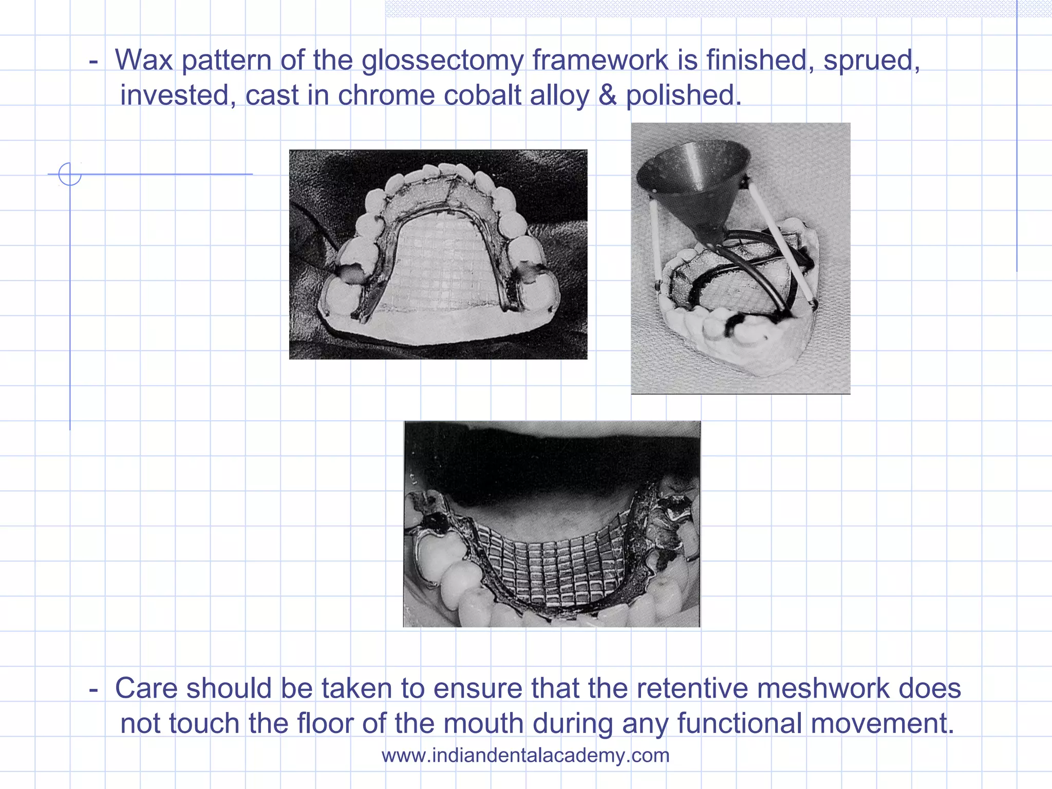 Glossectomy/ dental crown & bridge courses | PPT