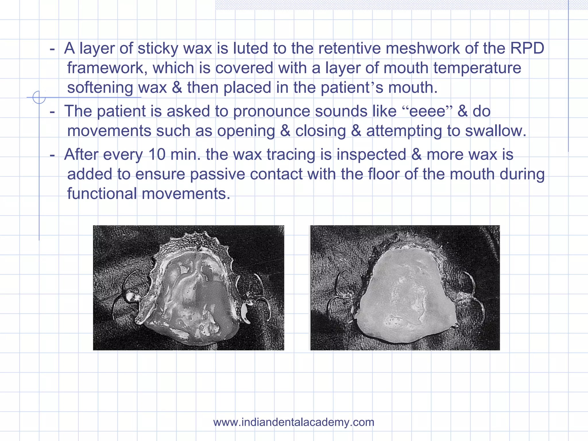 Glossectomy/ dental crown & bridge courses | PPT