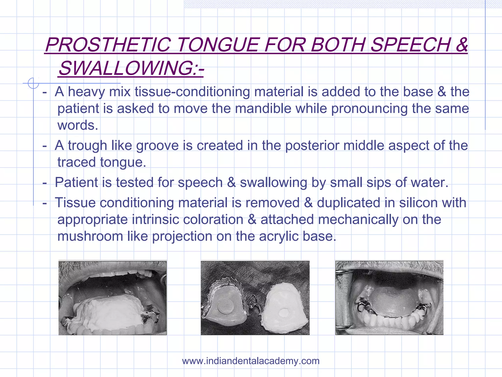 Glossectomy/ dental crown & bridge courses | PPT